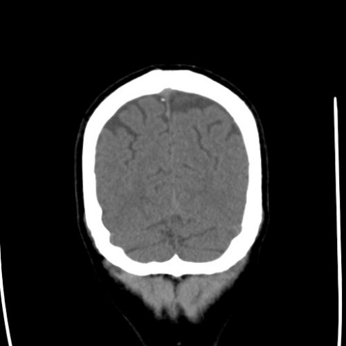 CTSCan Coronal - Skull, Head, and Neck CTs - embodi3D.com