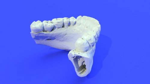 Mandible .stl - Dental, Orthodontic, Maxillofacial - embodi3D.com
