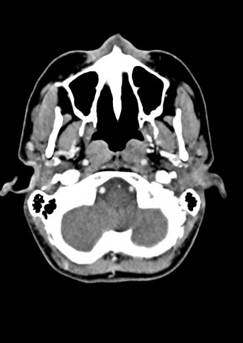 Neck CT - Skull, Head, and Neck CTs - embodi3D.com