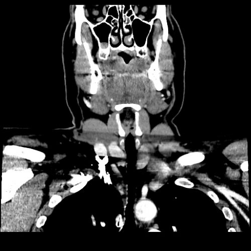neck - Skull, Head, and Neck CTs - embodi3D.com