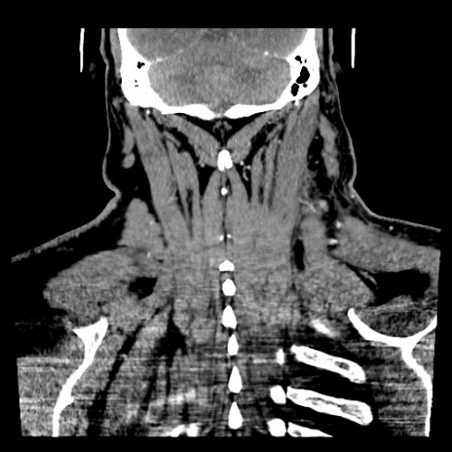 neck - Skull, Head, and Neck CTs - embodi3D.com