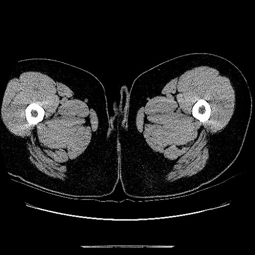 ct pelvic scan 2 - Lower Extremity CTs - embodi3D.com