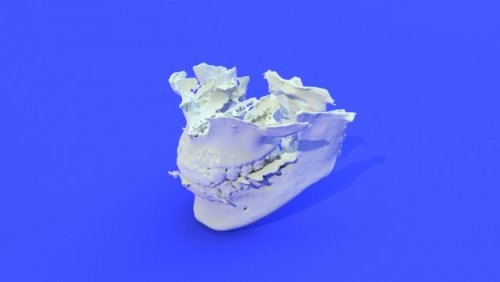 CBCT HB - stl file processed - Dental, Orthodontic, Maxillofacial ...