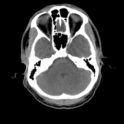 ct 6-9-21 head 5s without - Skull, Head, and Neck CTs - embodi3D.com