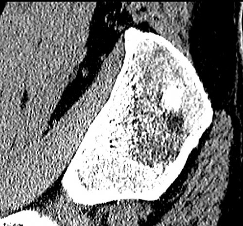 4 LS SAG - imageType DERIVED-PRIMARY-AXIAL-CT_SOM5 MPR - Spine CTs ...