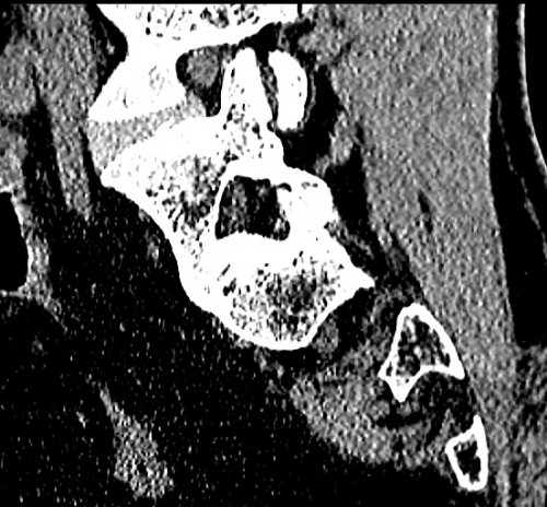 4 LS SAG - imageType DERIVED-PRIMARY-AXIAL-CT_SOM5 MPR - Spine CTs ...