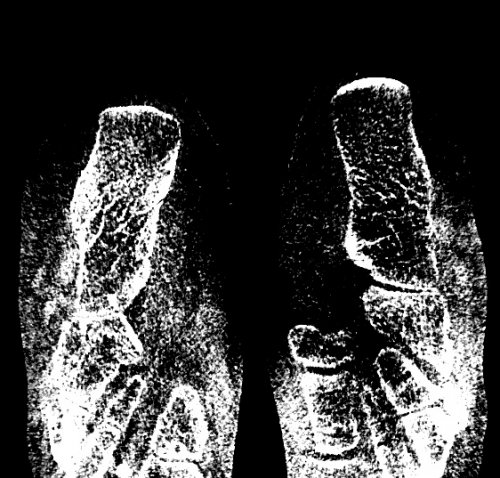 dsadsad - Lower Extremity CTs - embodi3D.com