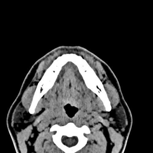 Facial 1 - Skull, Head, and Neck CTs - embodi3D.com