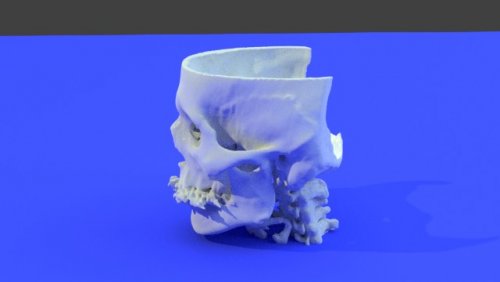 mandible - stl file processed - Dental, Orthodontic, Maxillofacial ...