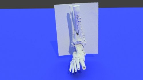 Leg Fracture - stl file processed - Extremity, Lower (Leg) - embodi3D.com