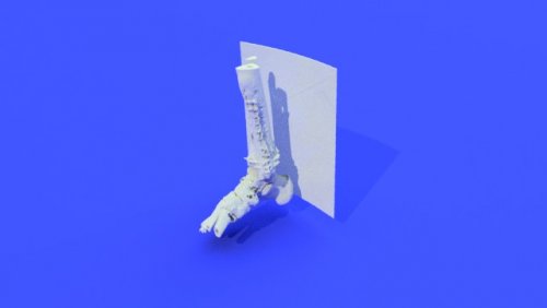 Leg Fracture - stl file processed - Extremity, Lower (Leg) - embodi3D.com