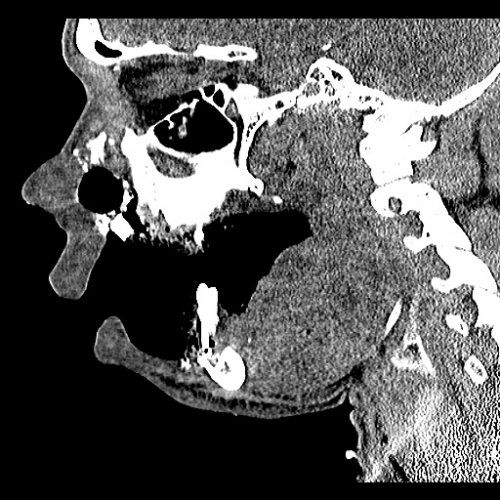 GSW face - Skull, Head, and Neck CTs - embodi3D.com