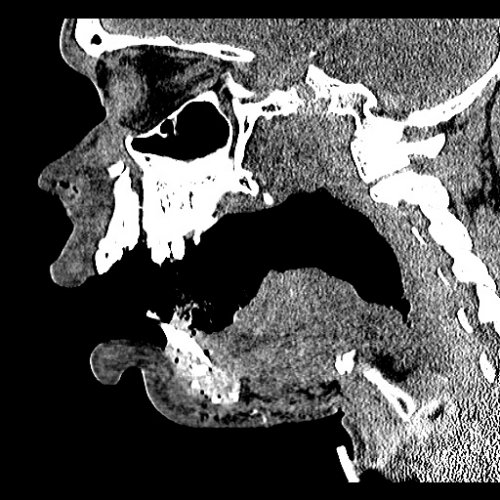 GSW face - Skull, Head, and Neck CTs - embodi3D.com
