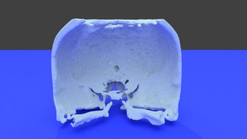 Brandon's CT scan (!) - stl file processed - Skull and Face - embodi3D.com