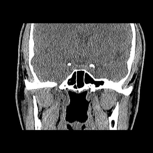 CT Scans of my sinuses - Skull, Head, and Neck CTs - embodi3D.com