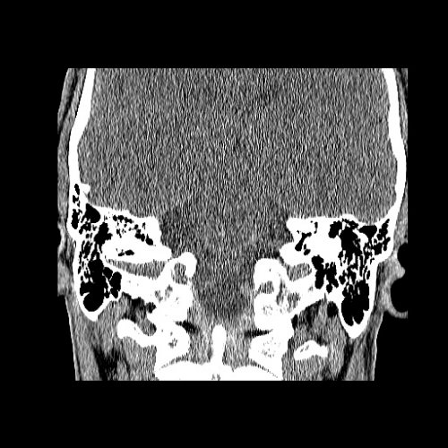 CT Scans of my sinuses - Skull, Head, and Neck CTs - embodi3D.com
