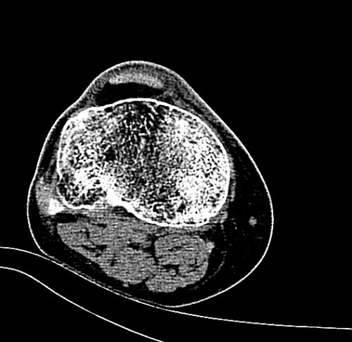 Foot - Lower Extremity CTs - embodi3D.com