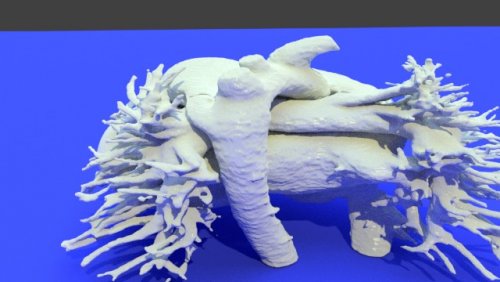 Model of human heart with patent ductus arteriosus (PDA) generated from ...