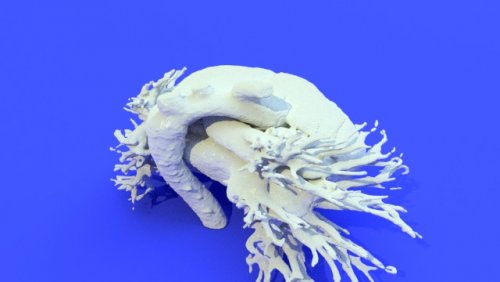 Model of human heart with patent ductus arteriosus (PDA) generated from ...