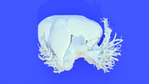 Model of human heart with patent ductus arteriosus (PDA) generated from ...
