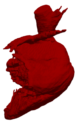 Model of human heart with patent ductus arteriosus (PDA) generated from ...