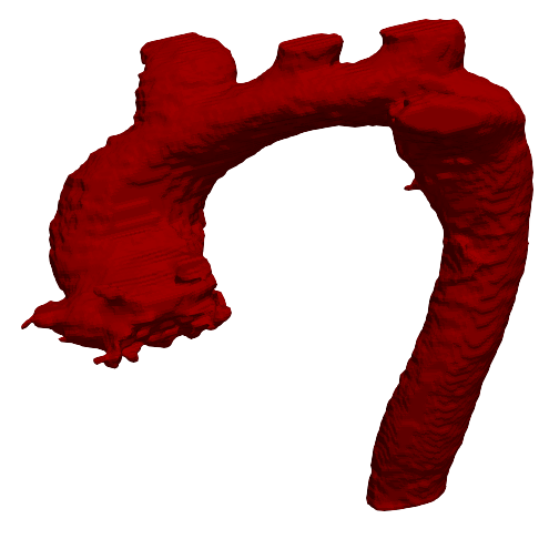 Model of human heart with patent ductus arteriosus (PDA) generated from ...