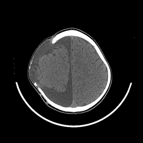 CT craneo - Skull, Head, and Neck CTs - embodi3D.com
