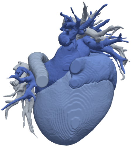 Model of human heart with ventricular septal defect (VSD) generated ...