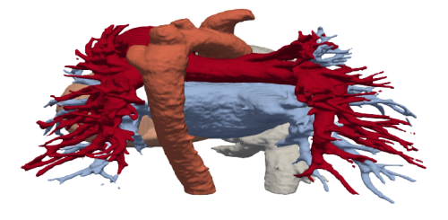 Model of human heart with patent ductus arteriosus (PDA) generated from ...