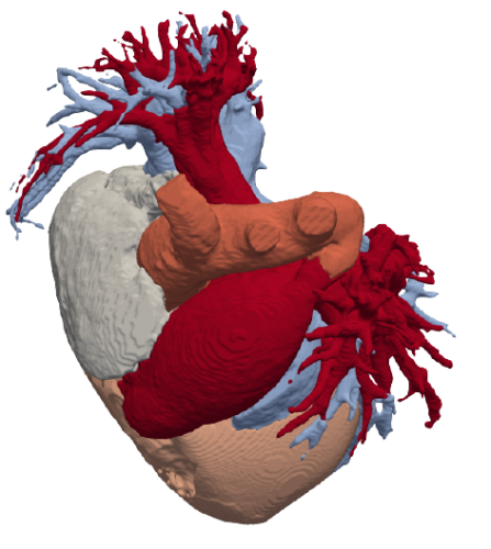 Model of human heart with patent ductus arteriosus (PDA) generated from ...