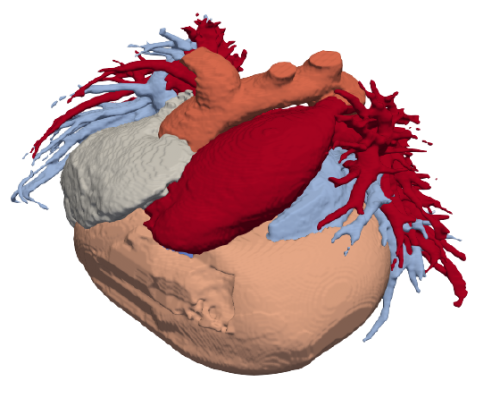Model of human heart with patent ductus arteriosus (PDA) generated from ...