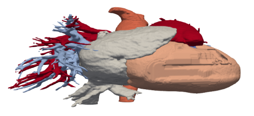Model of human heart with patent ductus arteriosus (PDA) generated from ...