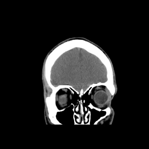 brain - Skull, Head, and Neck CTs - embodi3D.com