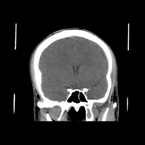 brain - Skull, Head, and Neck CTs - embodi3D.com