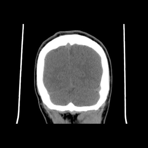 brain - Skull, Head, and Neck CTs - embodi3D.com