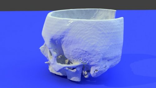 CT scan - stl file processed - Skull and Face - embodi3D.com