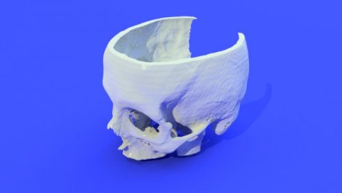 CT scan - stl file processed - Skull and Face - embodi3D.com