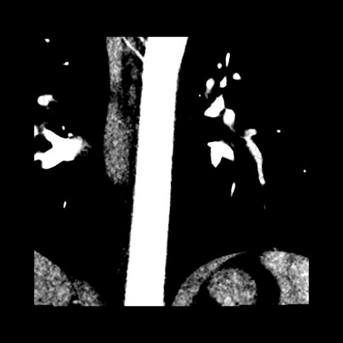 Coronal Chest - Thorax CTs - embodi3D.com