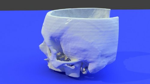 CT scan - stl file processed - Skull and Face - embodi3D.com