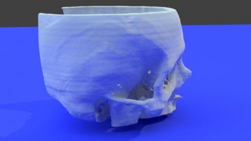 CT scan - stl file processed - Skull and Face - embodi3D.com