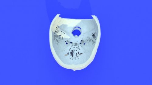 CT scan - stl file processed - Skull and Face - embodi3D.com