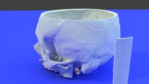 CT scan - stl file processed - Skull and Face - embodi3D.com