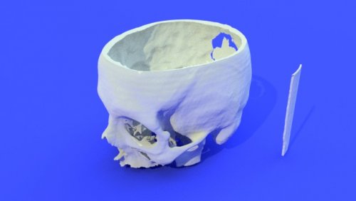 CT scan - stl file processed - Skull and Face - embodi3D.com