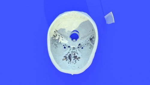 CT scan - stl file processed - Skull and Face - embodi3D.com