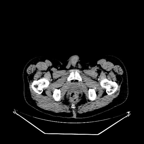 CT-bodyIMAGES- muscles - Abdomen and Pelvis CTs - embodi3D.com