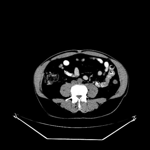 CT-bodyIMAGES- muscles - Abdomen and Pelvis CTs - embodi3D.com