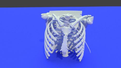 CT chest - stl file processed - democratiz3D® Processing - embodi3D.com