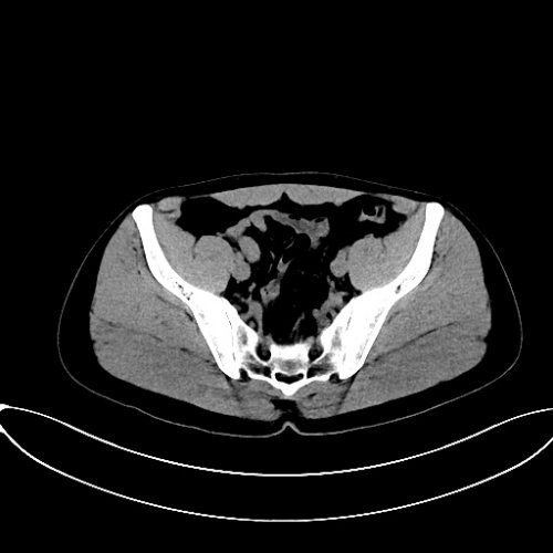 CT ABD TEST - Abdomen and Pelvis CTs - embodi3D.com