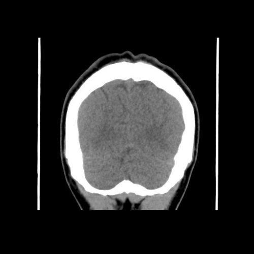 ct head - Skull, Head, and Neck CTs - embodi3D.com