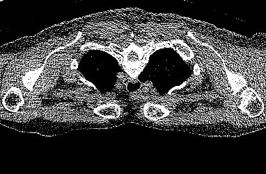 Fibrous Dysplasia Ribs - Thorax CTs - embodi3D.com